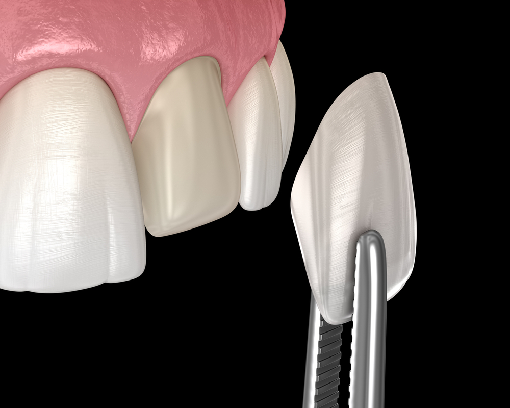 Fatete dentare – Dentistry Kraft